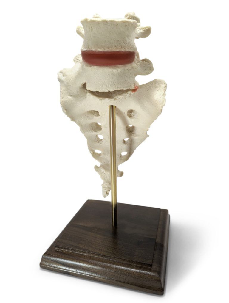 Bertolotti Syndrome and the Lumbosacral Transition Anatomy