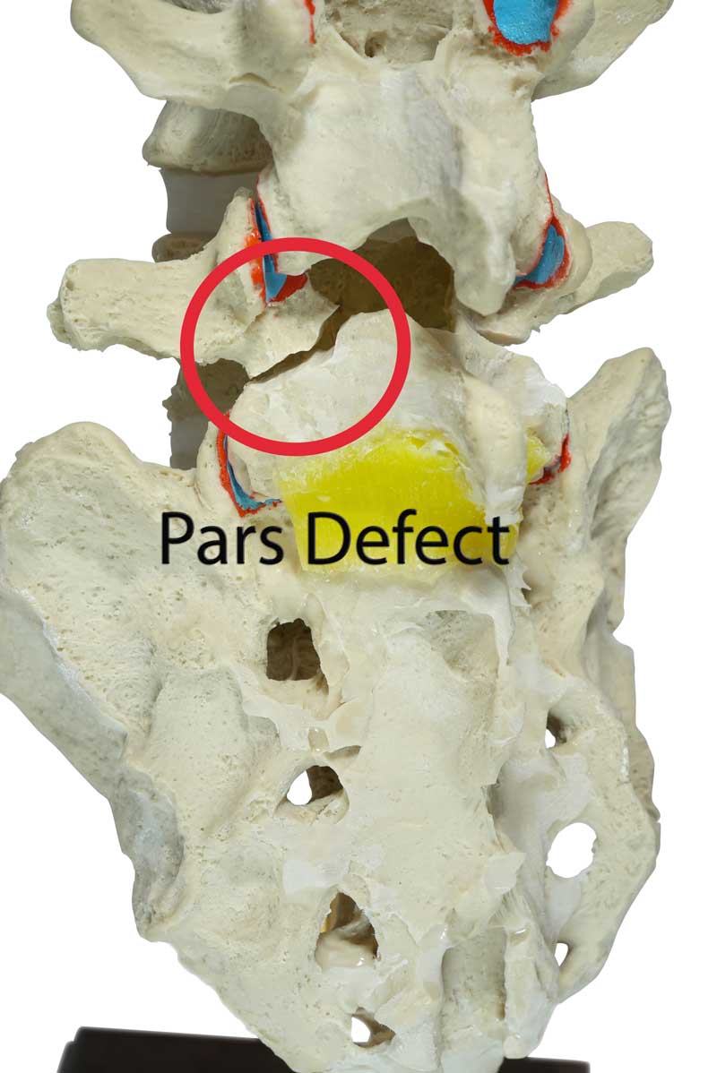 Pars Fracture Model | L4-Sacrum Vertebrae 3d Model